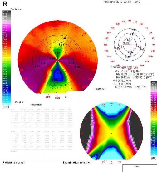 Pellucid Marginal Corneal Degeneration - EyeWiki