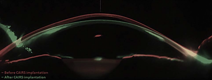 Corneal Tissue Addition Techniques: CAIRS and CTAK - EyeWiki