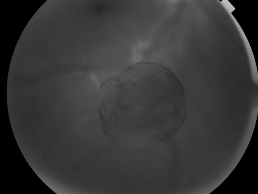 Vitreous Cysts - EyeWiki
