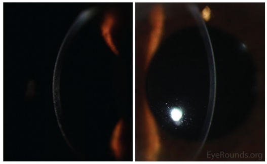 Meesmann Corneal Dystrophy - EyeWiki