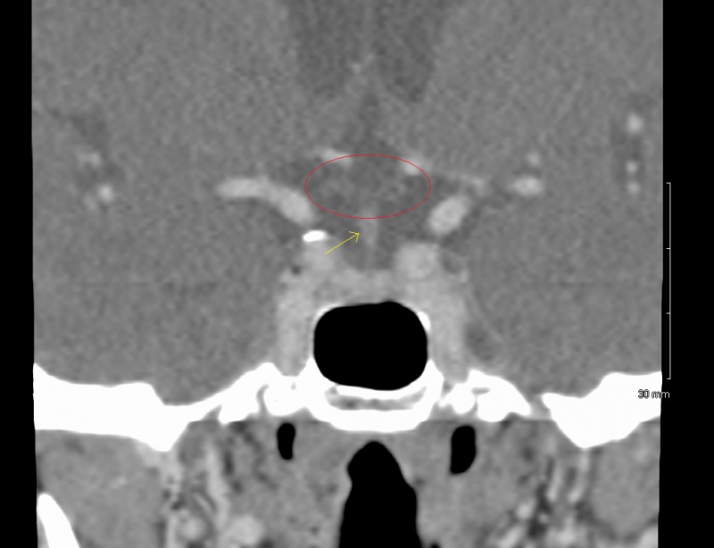 Tilted Disc Syndrome - EyeWiki